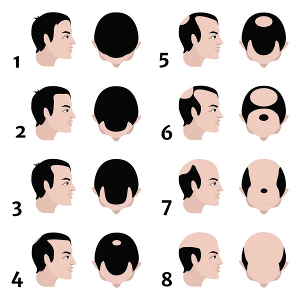 100,000 Male baldness chart Vector Images | Depositphotos