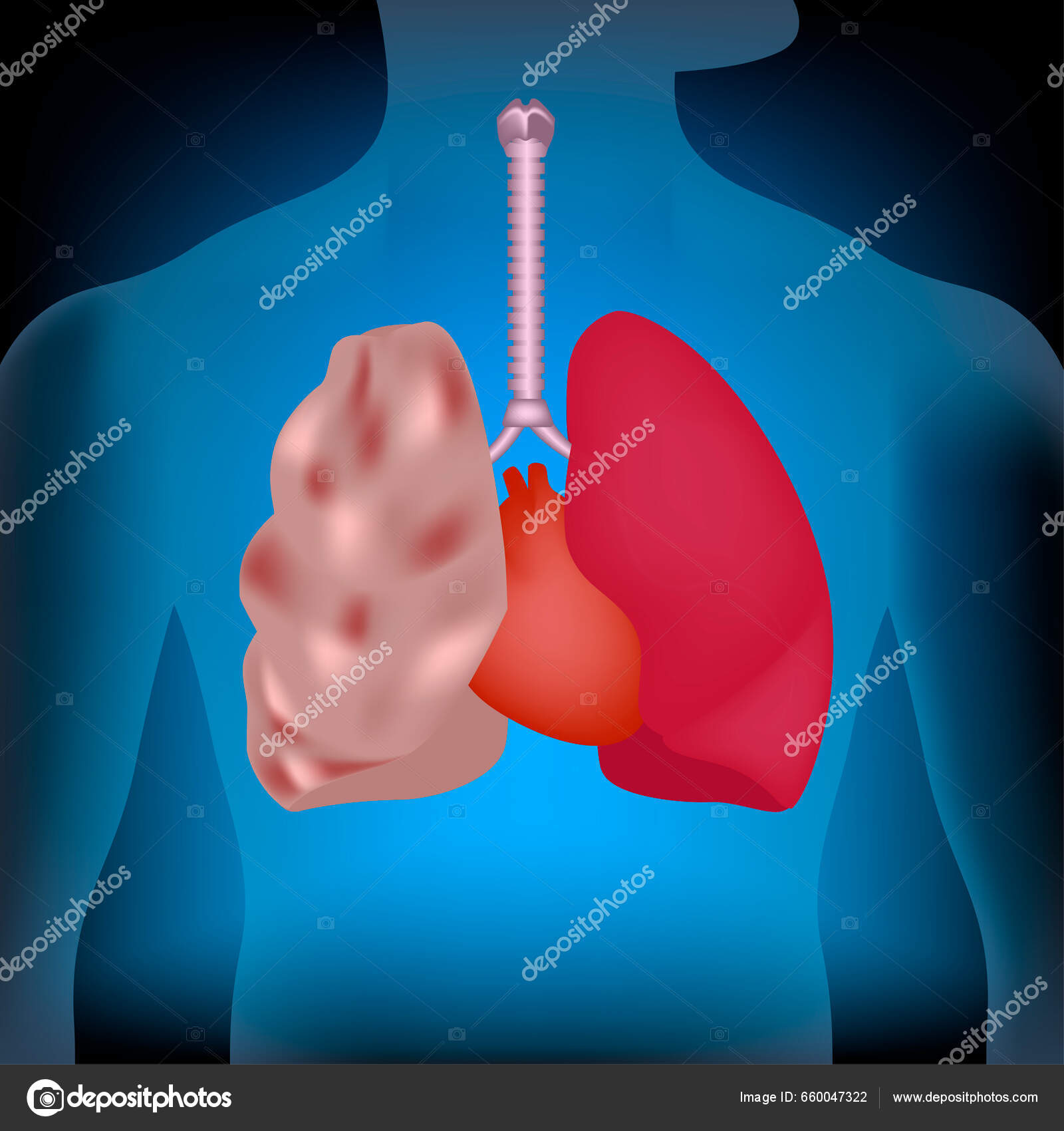 Lungeanatomi Diagram Lungene, Anatomi, Medisinsk