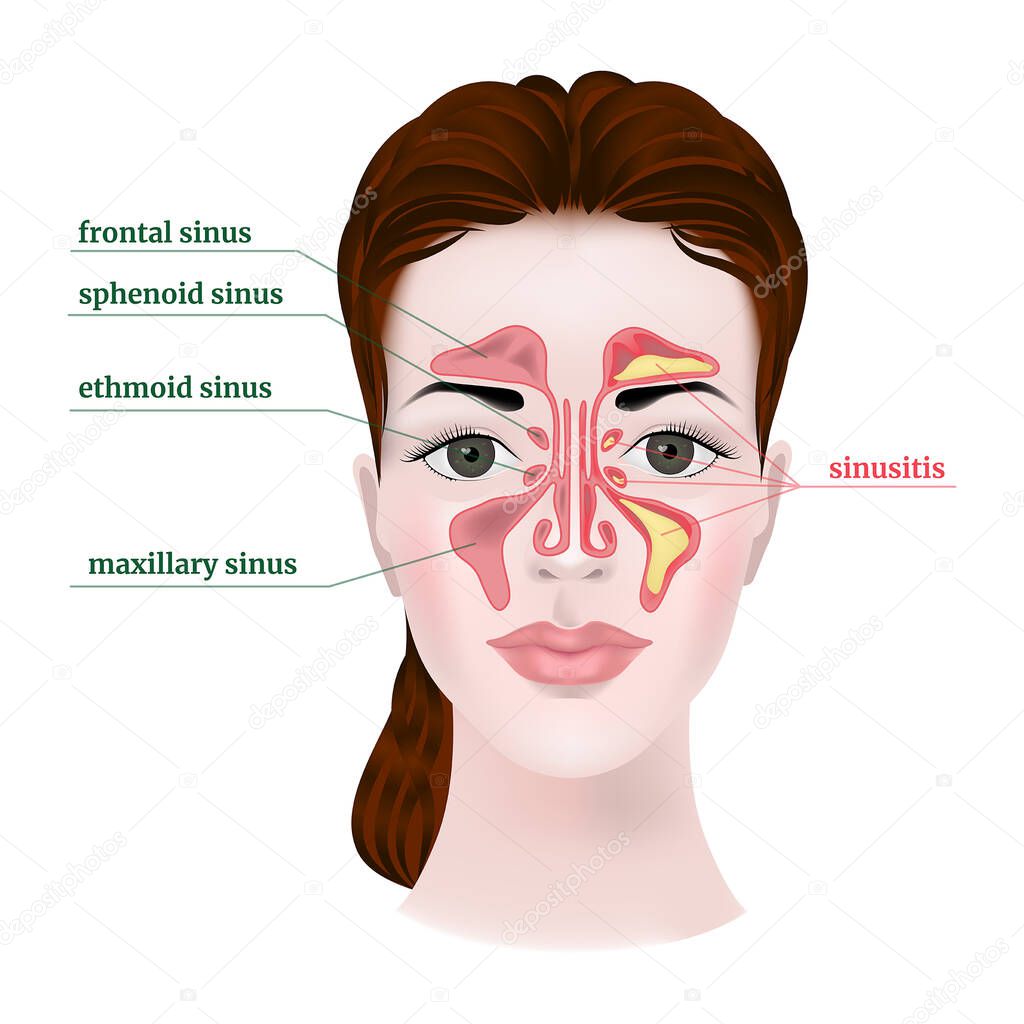The face of a girl with the anatomy of the maxillary sinuses, with a ...
