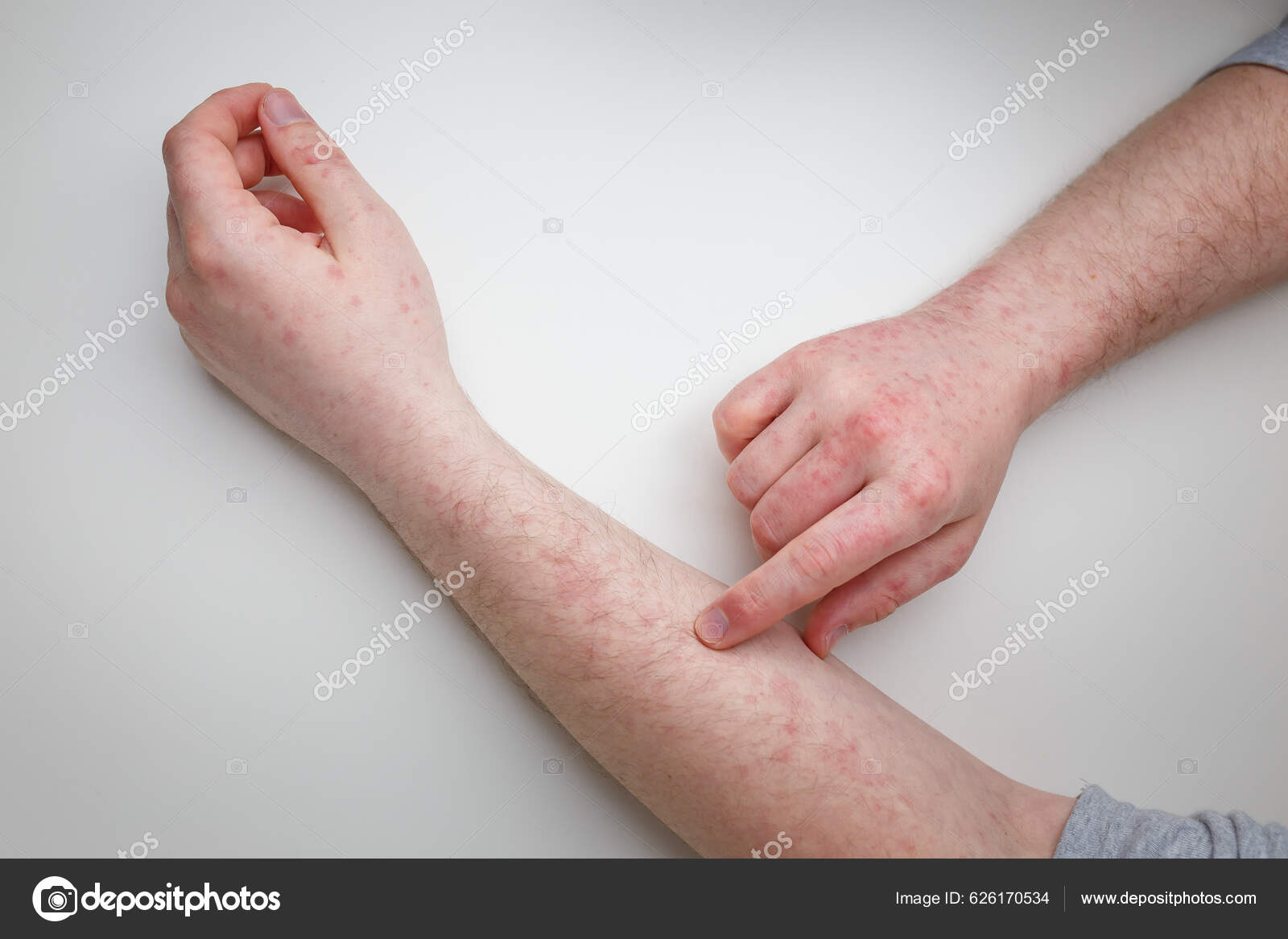 Dermatitis On Top Of Hands