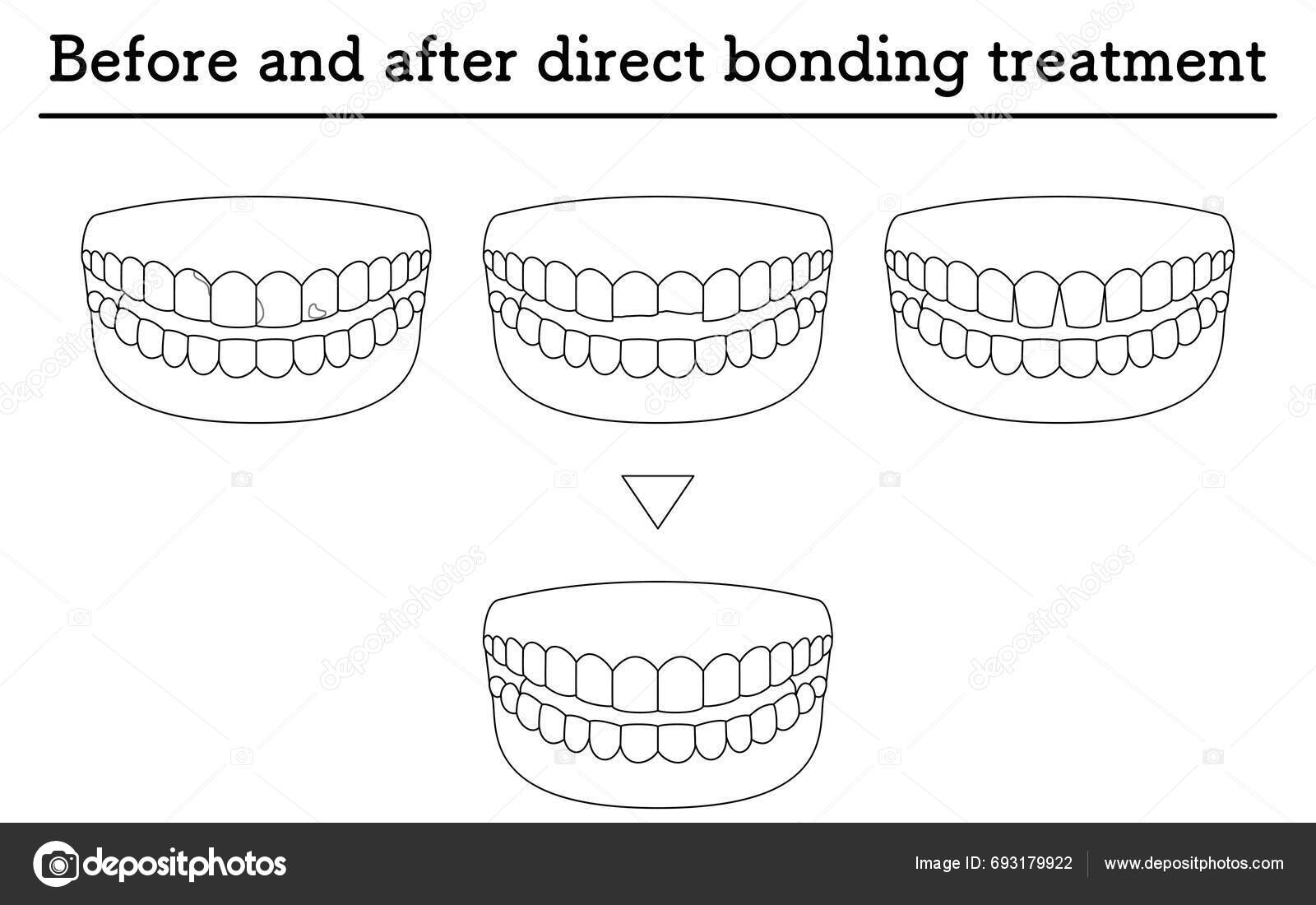 Cosmetic Dentistry Treatment Direct Bonding Decayed Chipped Teeth Gaps ...