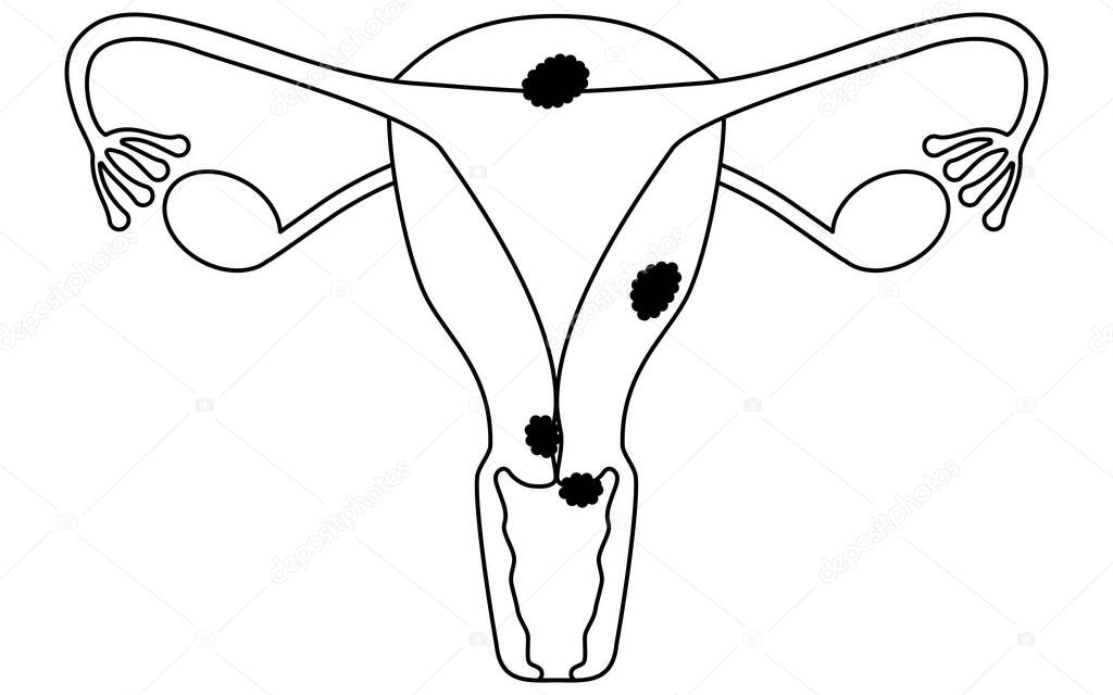 Ilustraci n diagram tica del c ncer de cuello uterino, anatom a del tero y ovarios, ilustraci n ...