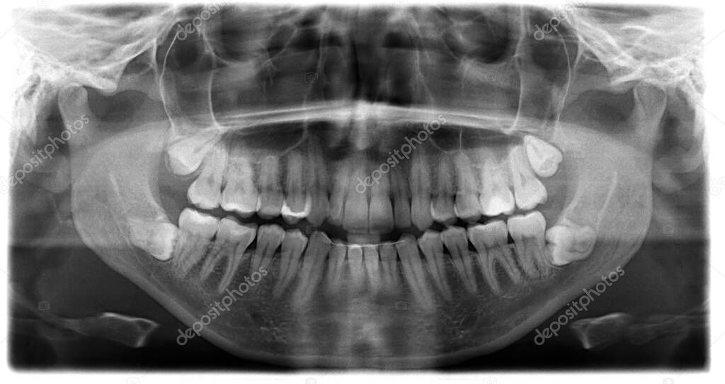 Orthopantomography, OPG X-ray DR digital wisdom teeth. panoramic film x ...