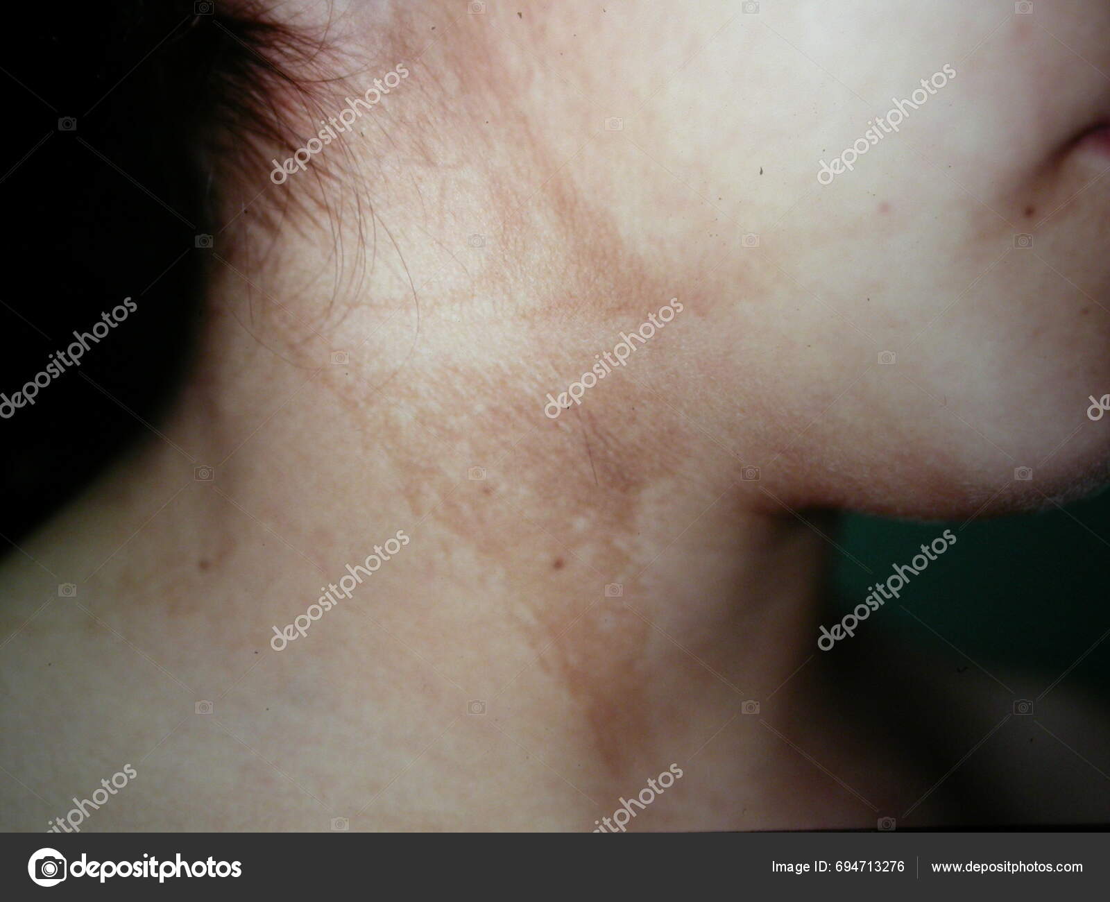 Woolly Hair Nevus Characterized Involvement Limited Scalp Curly ...