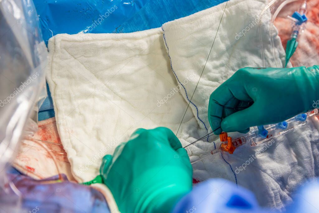 Proceso de colocaci n de stent card aco en quir fano. M dico del coraz n insertando cat ter ...