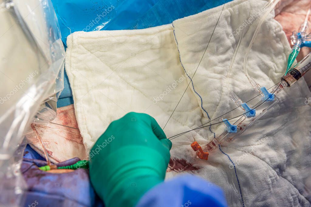 Proceso de colocación de stent cardíaco en quirófano. Médico del ...