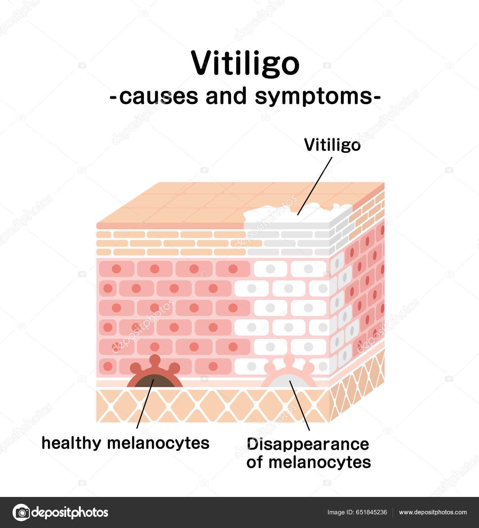 Causes Symptoms Vitiligo Vector Illustration Stock Vector by ©barks ...
