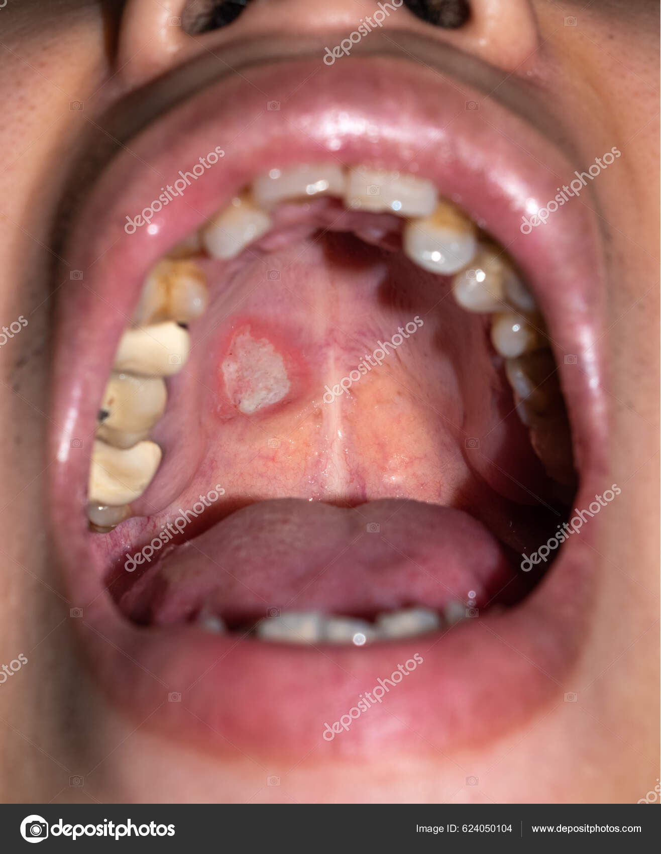 Aphthous Ulcer Stress Ulcer Mouth Asian Male Patient — Foto stock di ...