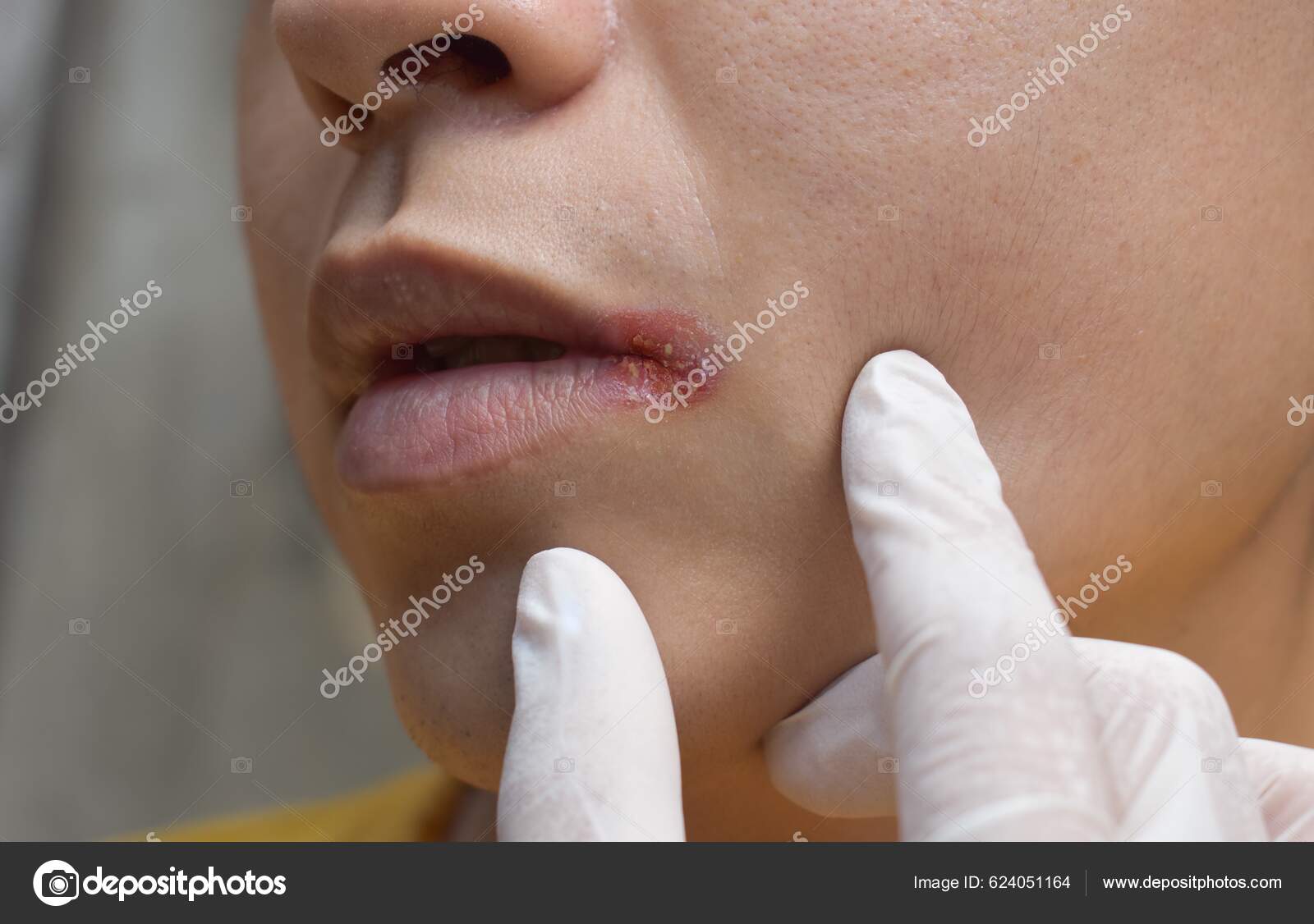 Estomatitis Angular Queilitis Angular Perleche Hombre Joven Asiático ... Estomatitis Angular Queilitis Angular Perleche Hombre Joven Asiático ...