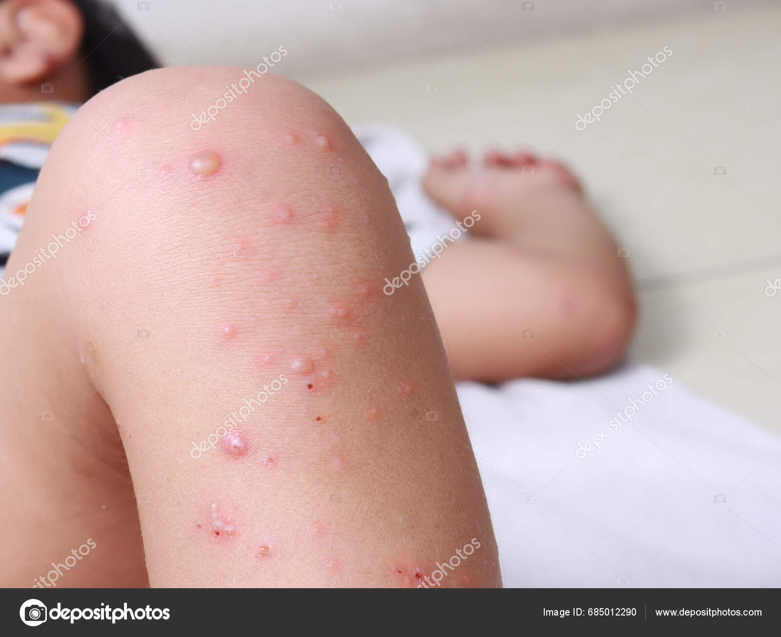 Virus Hfmd Leg Knee Child Asian Allergic Blister Chicken Pox — Stock ...