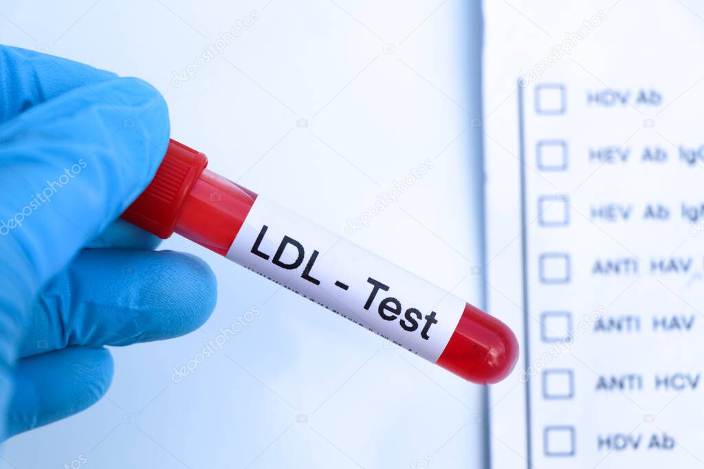 Examen de LDL para buscar anormalidades de la sangre, muestra de sangre ...
