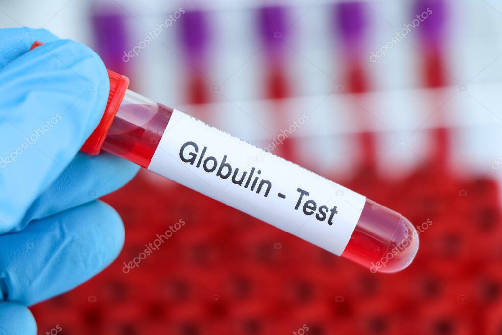 Examen de globulina para buscar anormalidades de la sangre, muestra de ...