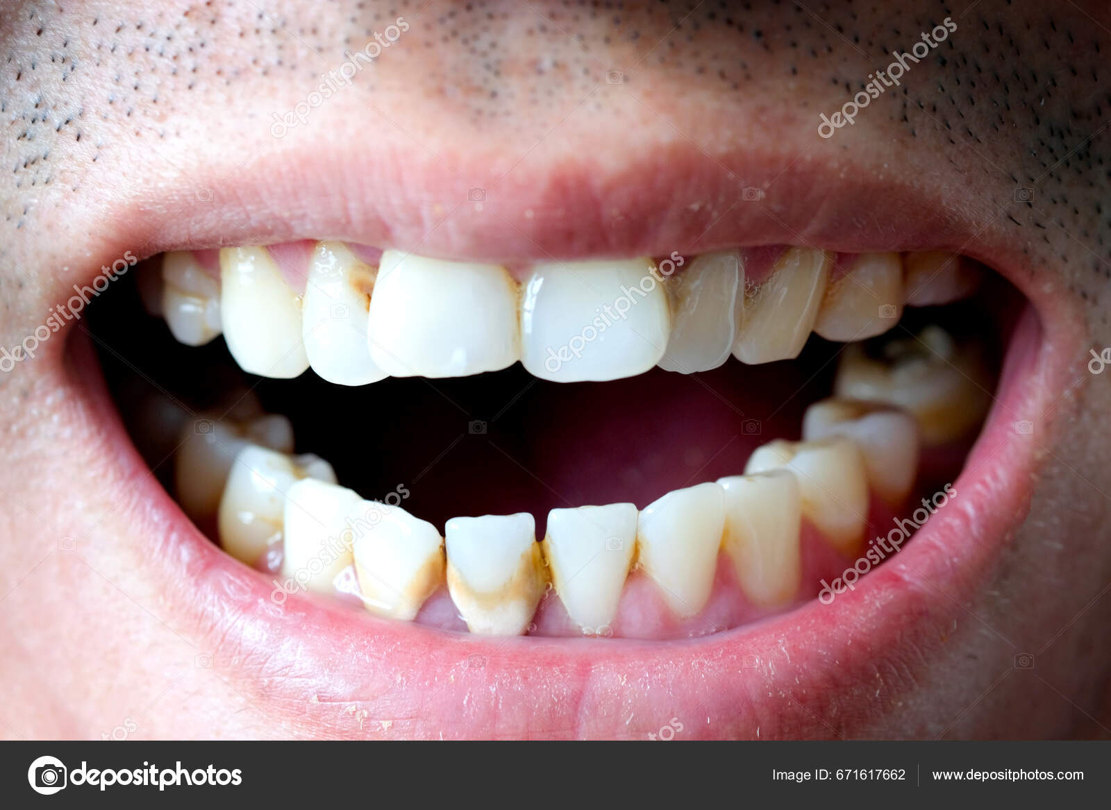 Tooth's Man Smoking Bad Man Smokes Cigarettes Have Tooth Decay — Stock ...