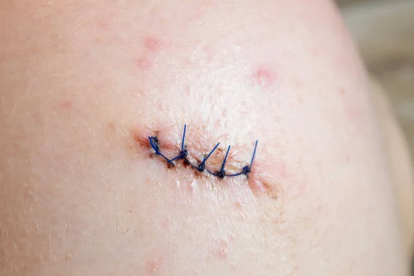 Skin stitches Stock Photos, Royalty Free Skin stitches Images ...