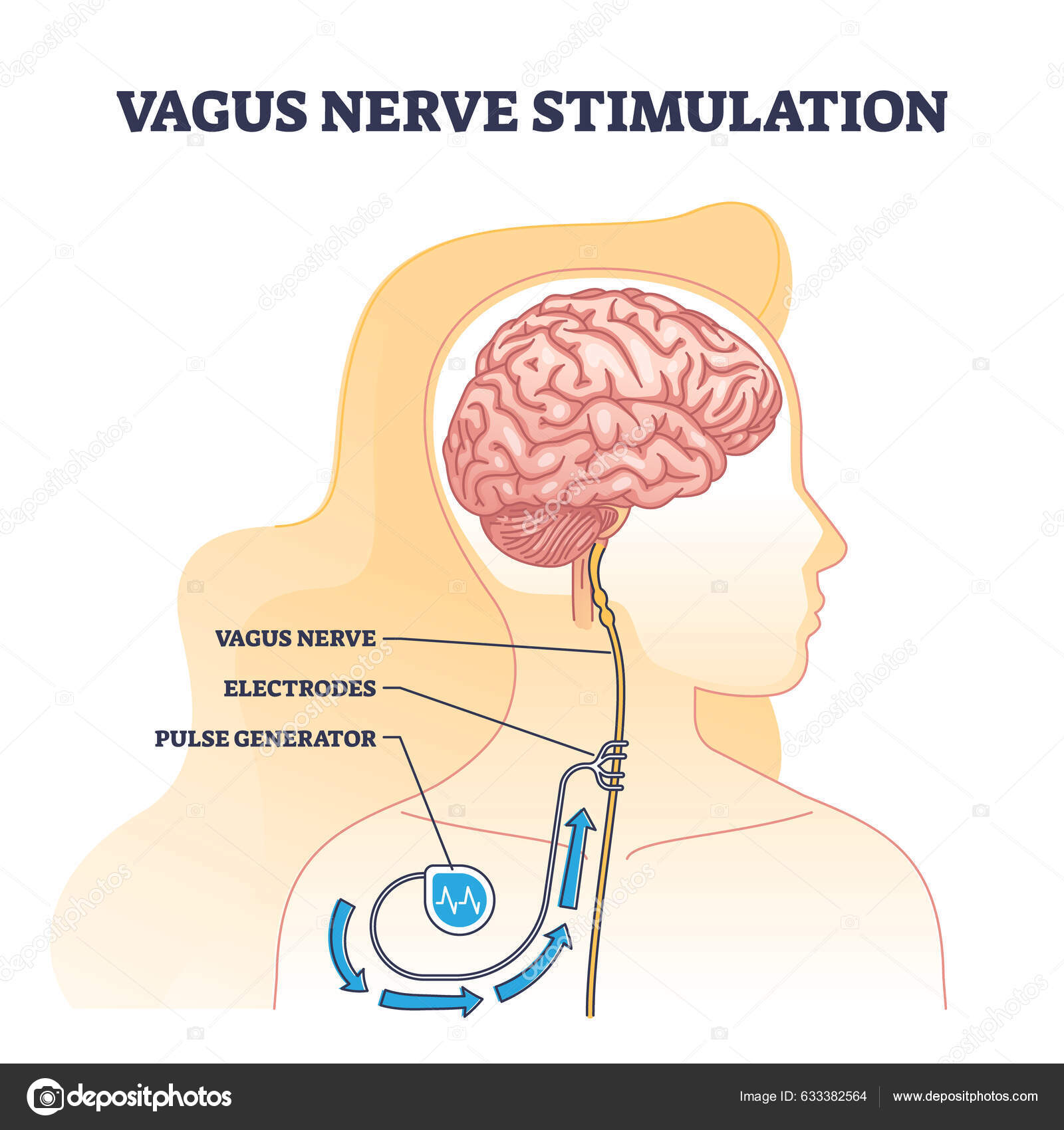 Vagus Nerve Stimulation Medical Device Implant Brain Outline Diagram Labeled Stock Vector Image ...
