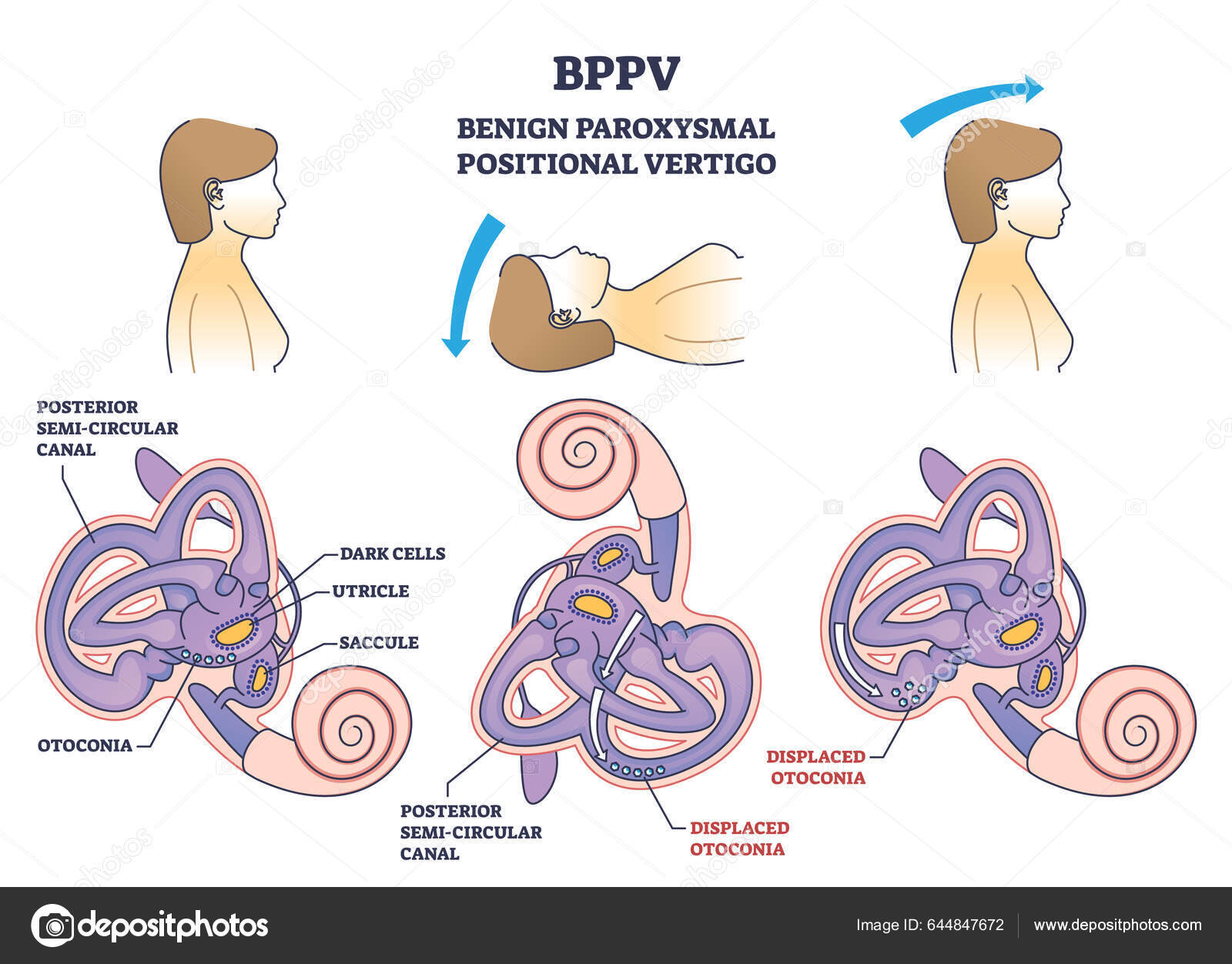 Schéma Général Syndrome Vertige Positionnel Paroxystique Bénin Bppv ...