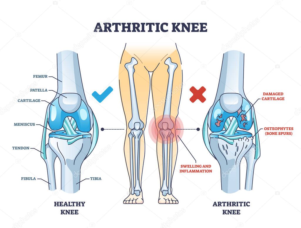 Artritis de rodilla o osteoartritis y huesos sanos diagrama de contorno ...