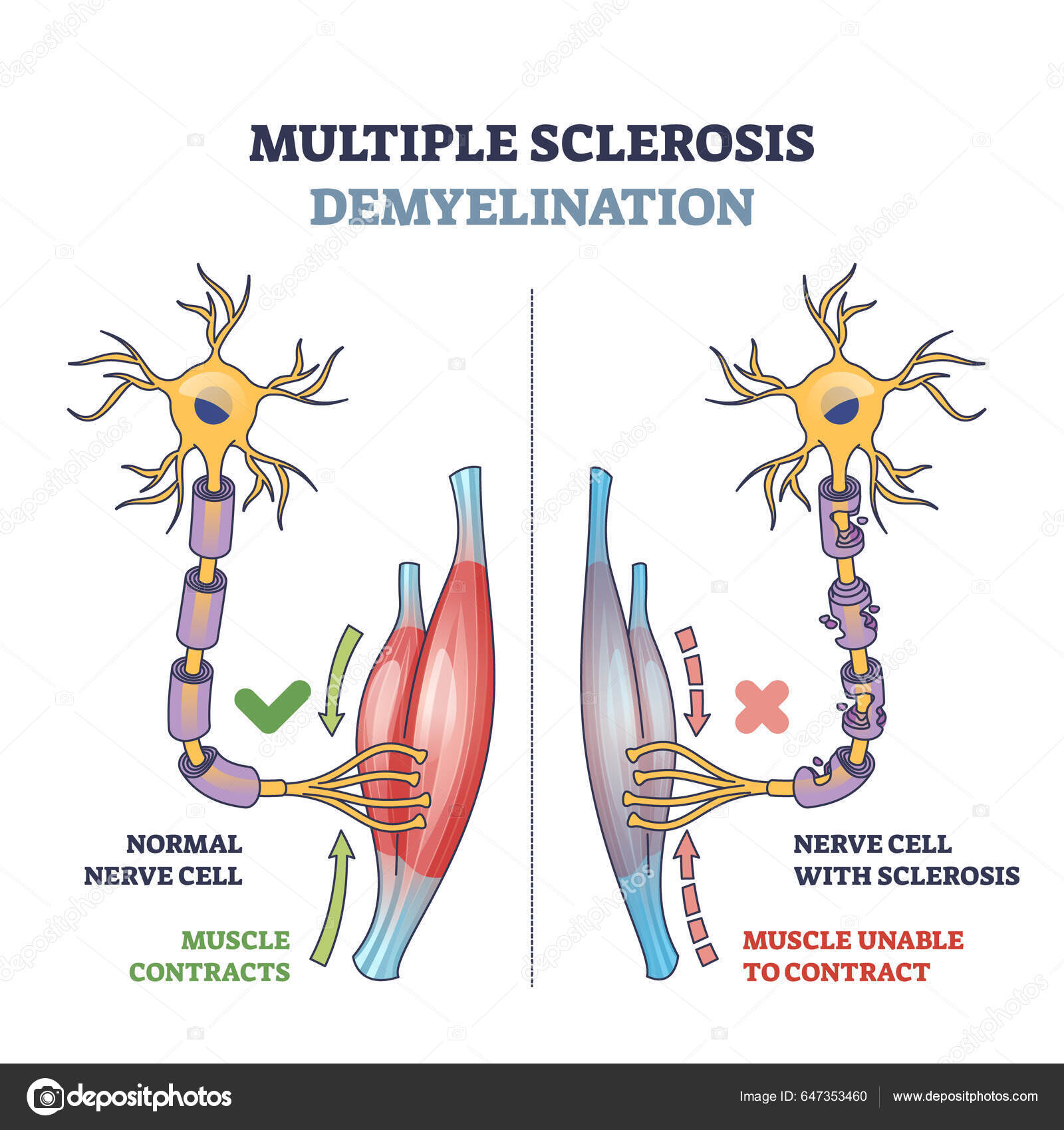 Desmielinización Esclerosis Múltiple Comparación Con Los Nervios Sanos ...