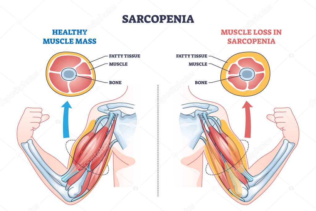 Sarcopenia como p rdida de masa muscular y diagrama de contorno de ...