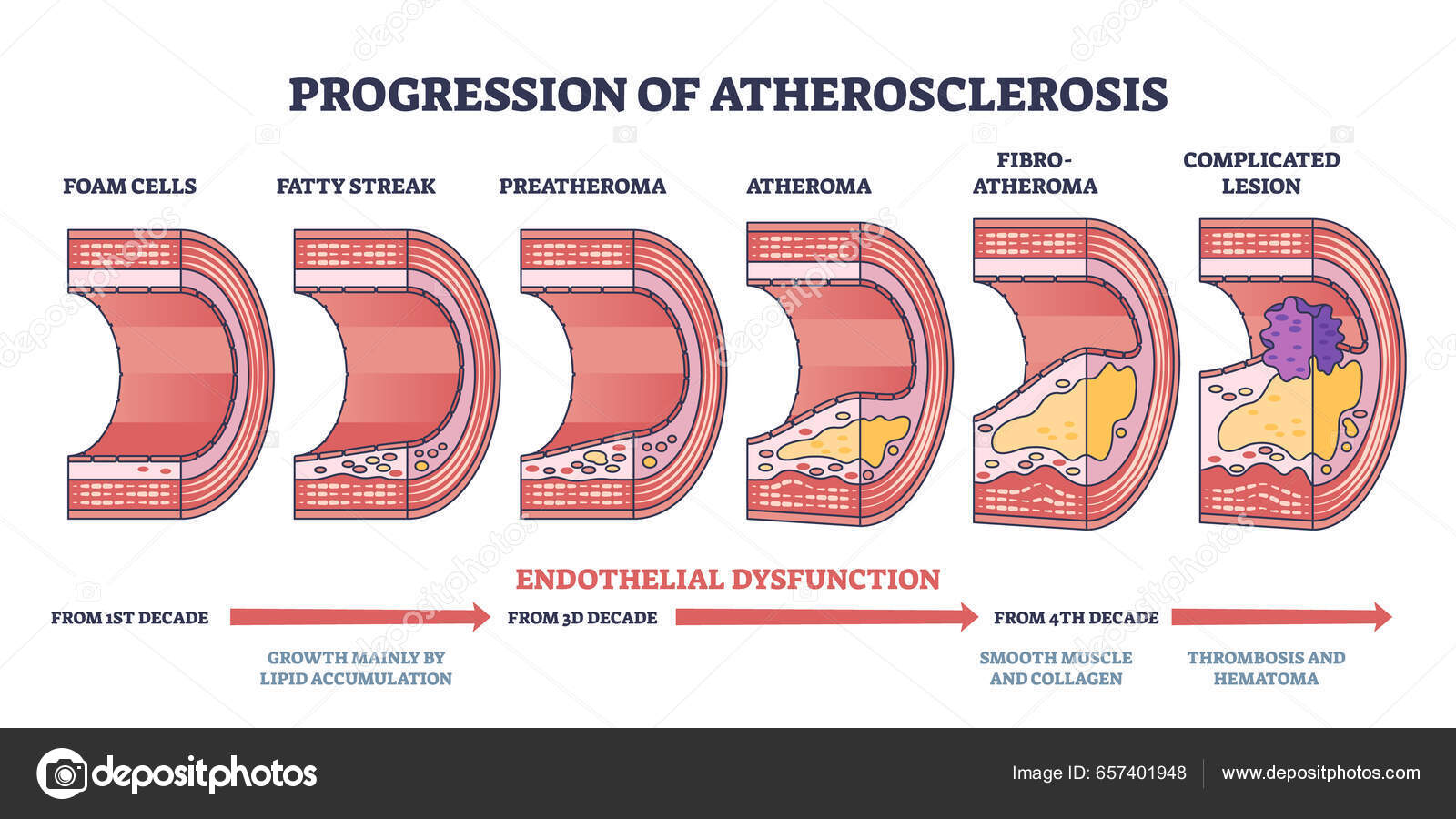 Progresi Aterosklerosis Dan Formasi Trombosis Garis Besar Dijuluki ...