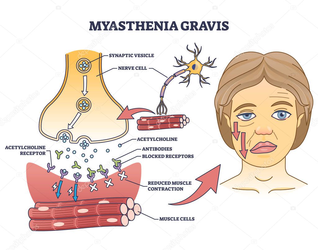 Miastenia Grave Come Autoimmune Malattia Neuromuscolare Schema Contorno ...