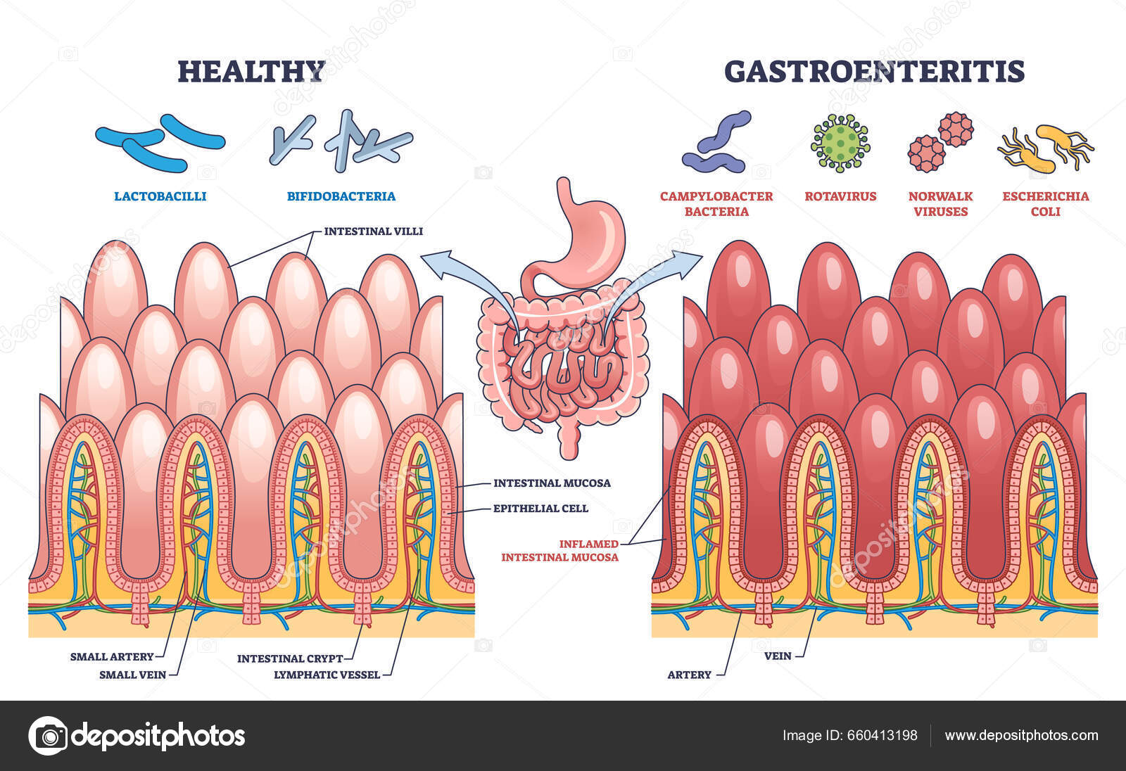 Gastroenteritis Stomach Flu Microbiological Explanation Outline Diagram ...