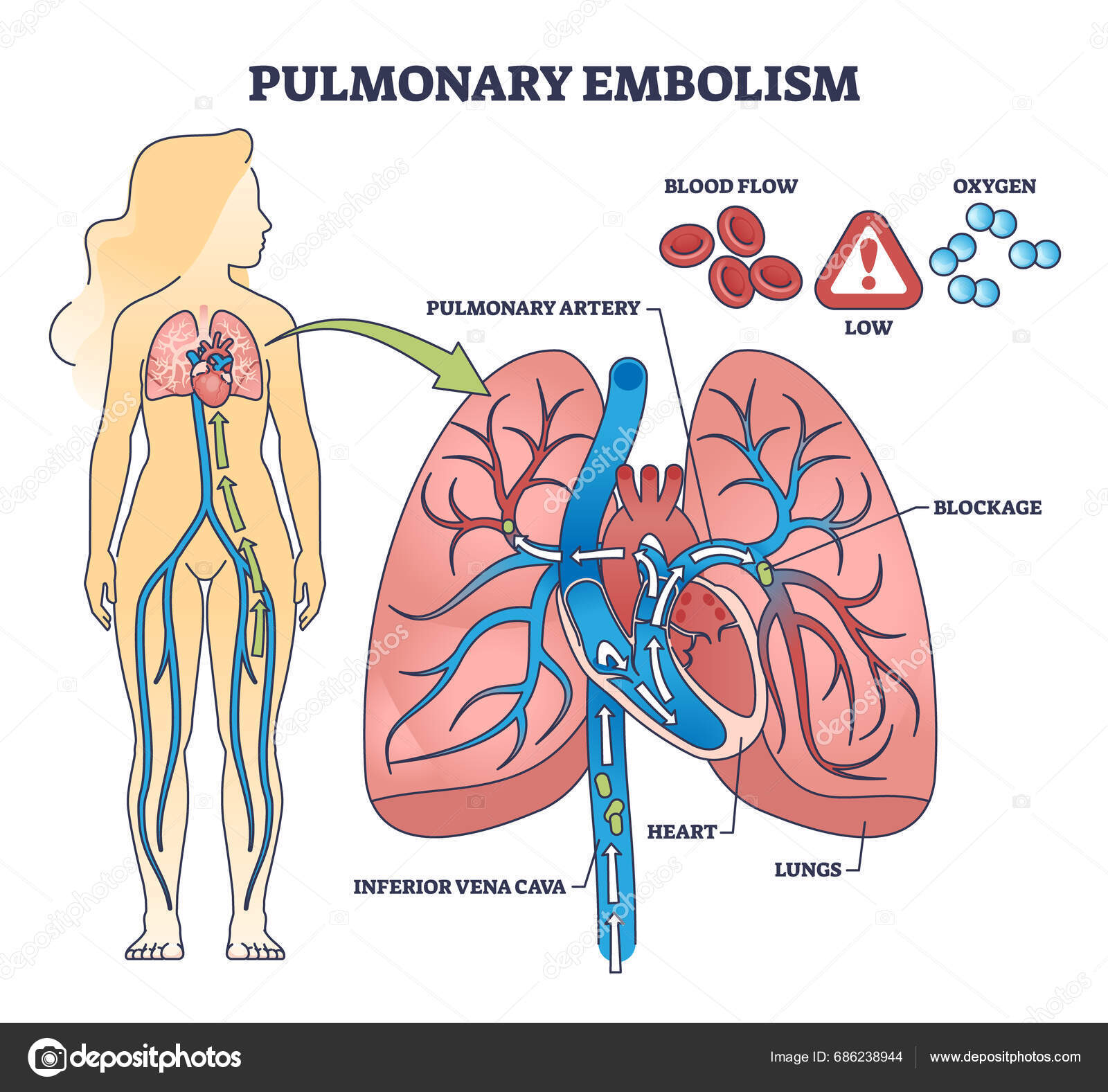 Embolia Pulmonar Com Bloqueio Fluxo Sanguíneo Diagrama Contorno Artéria ...
