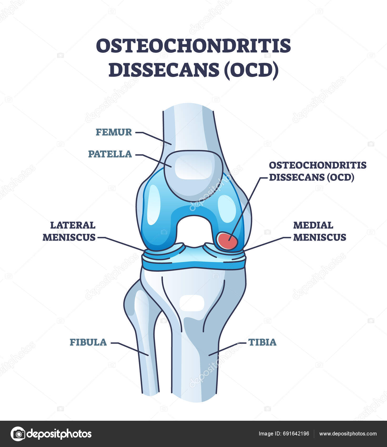 Osteocondritis Disecante Ocd Hueso Cartílago Condición Esquema Diagrama ...