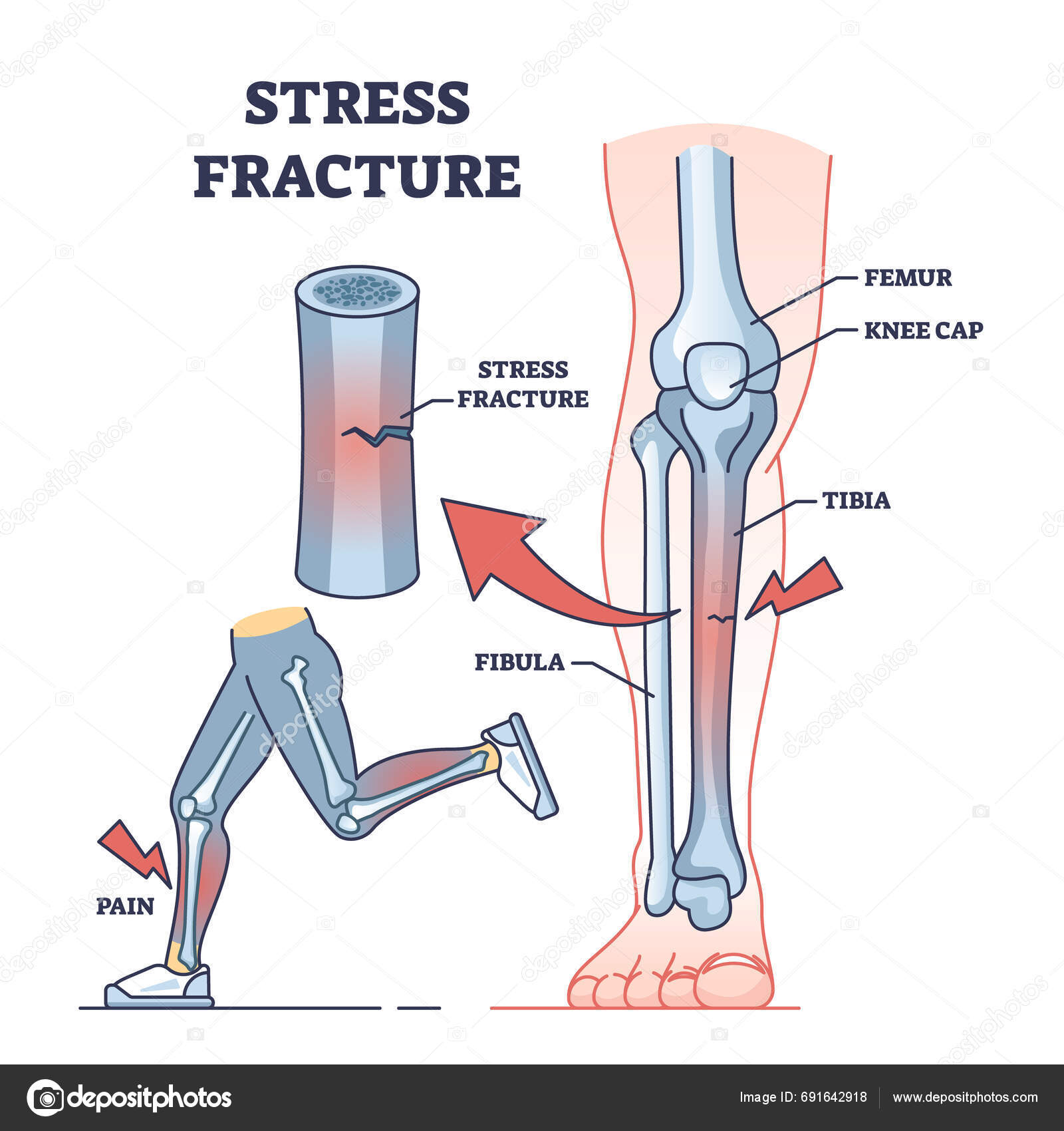Stress Fracture Skeletal Bone Injury Physical Overuse Outline Diagram ...