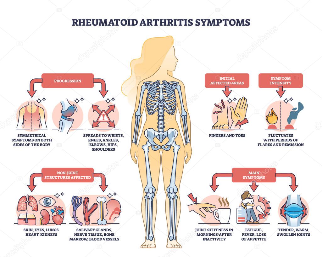 Síntomas de la artritis reumatoide con la inflamación de las articulaciones esquema de la ...