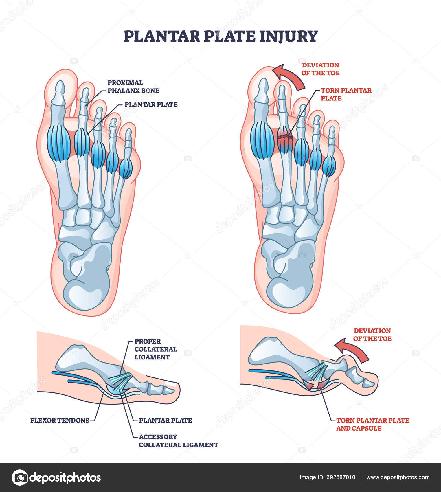Anatomie Einer Plattenverletzung Und Zerrissene Fusskapsel Rahmen Eines ...