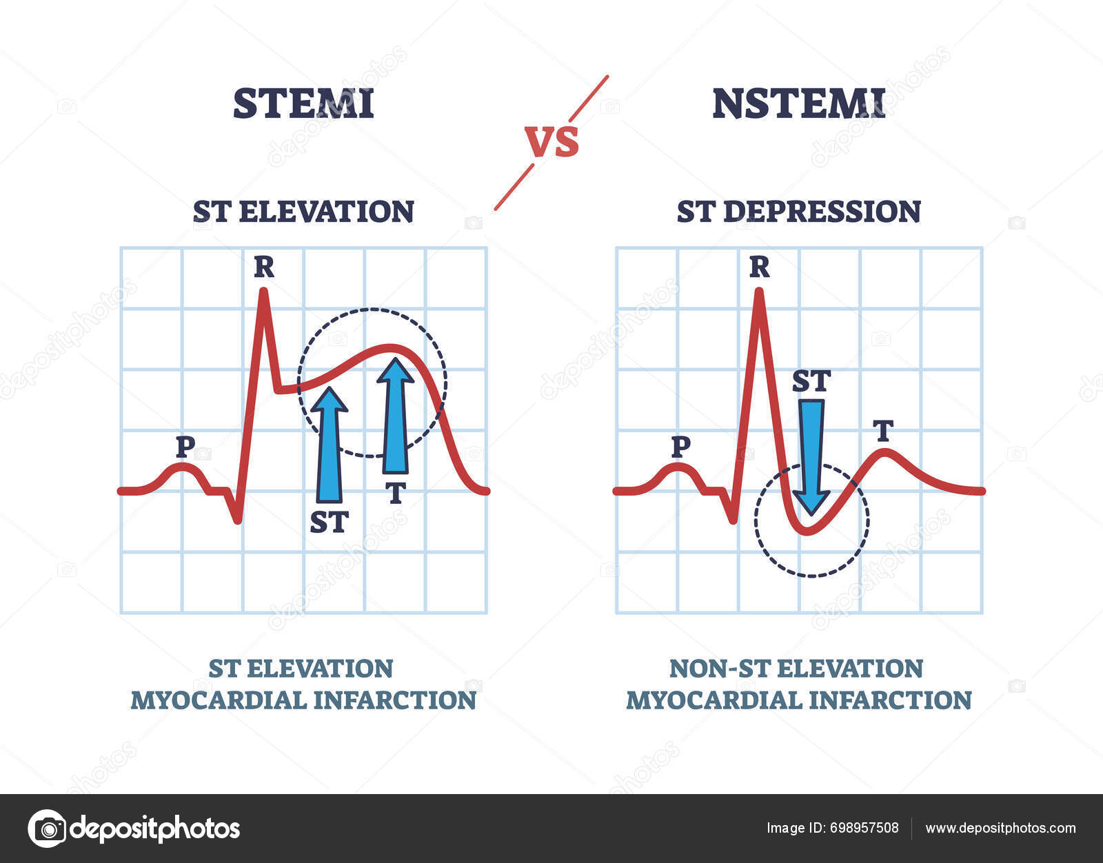 心功能可视化示意图中的Stemi对Nstem心脏跳动冲动 心电图或心电图与St抬高和抑郁比较矢量说明 心肌梗死例 图库矢量图©VectorMine 698957508