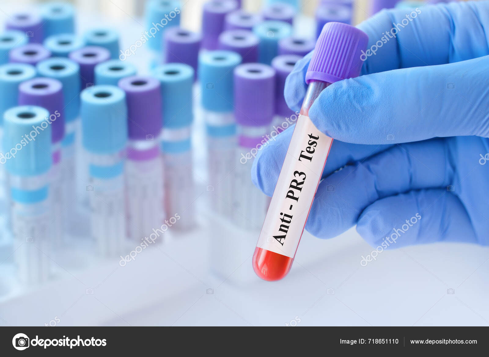 Médico Sosteniendo Tubo Muestra Sangre Prueba Con Prueba Pr3 Proteinasa — Foto de stock ...