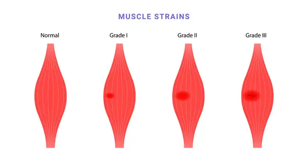 Muscle strain Vector Images | Depositphotos