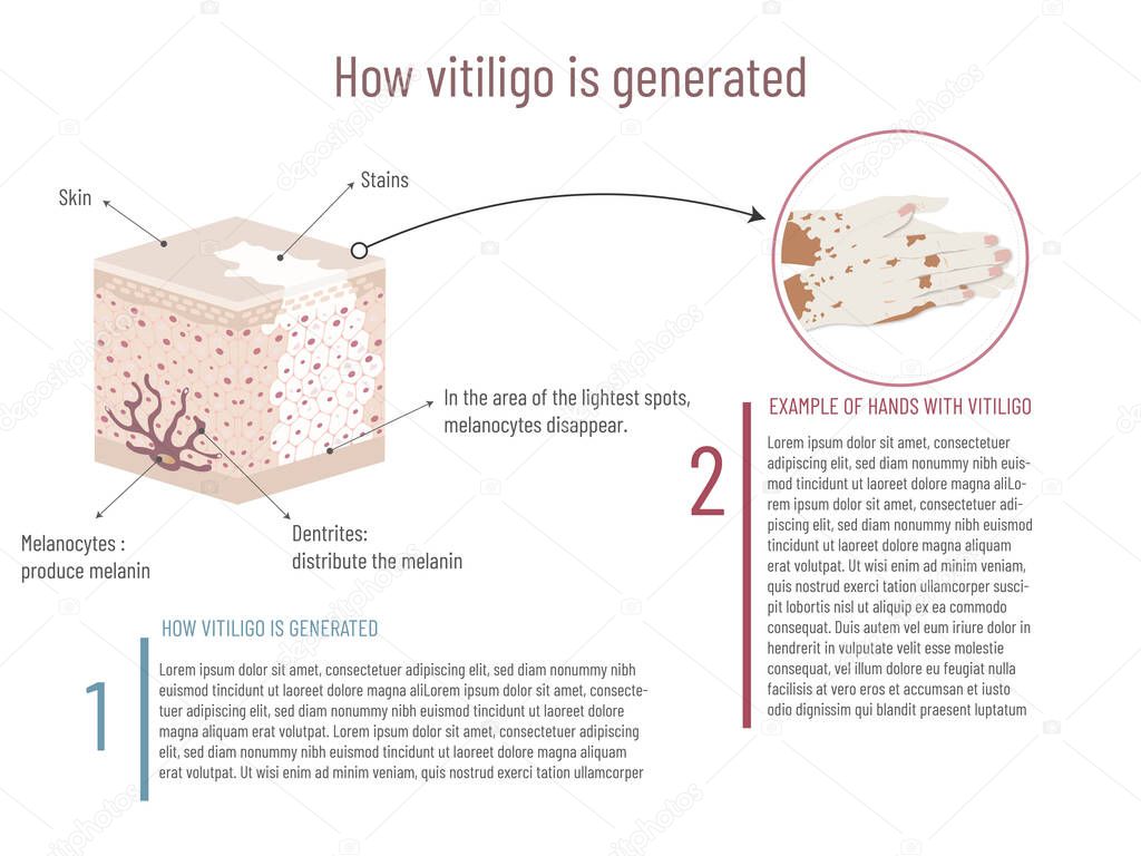 Infografía del origen del vitiligo y ejemplo visual en las manos ...