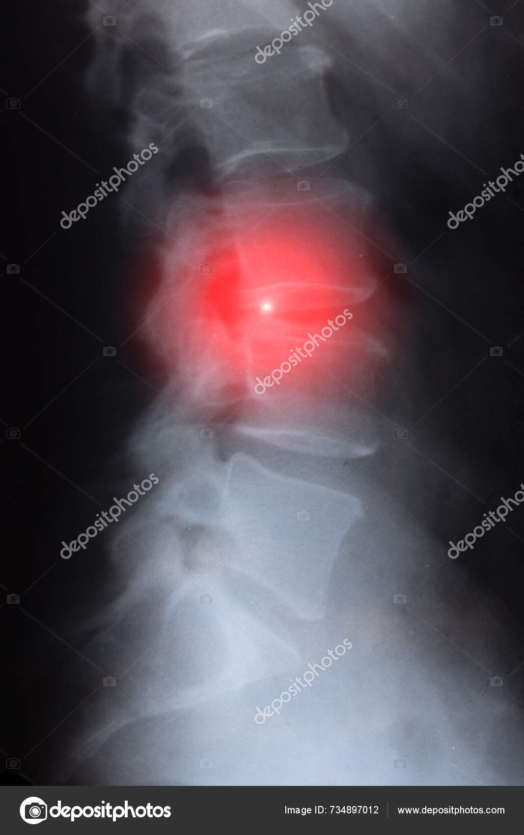 Vertical Ray Mri Mrt Human Spine Defects Bones Vertebrae Medical ...