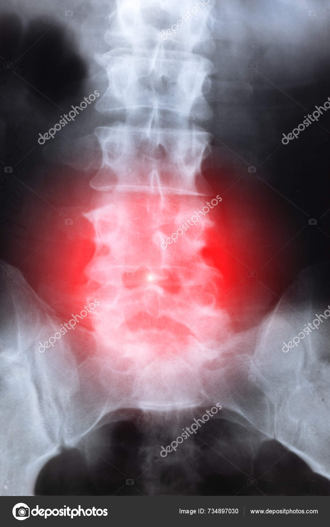 Ray Mri Mrt Human Spine Defects Bones Vertebrae Medical Treatmant ...