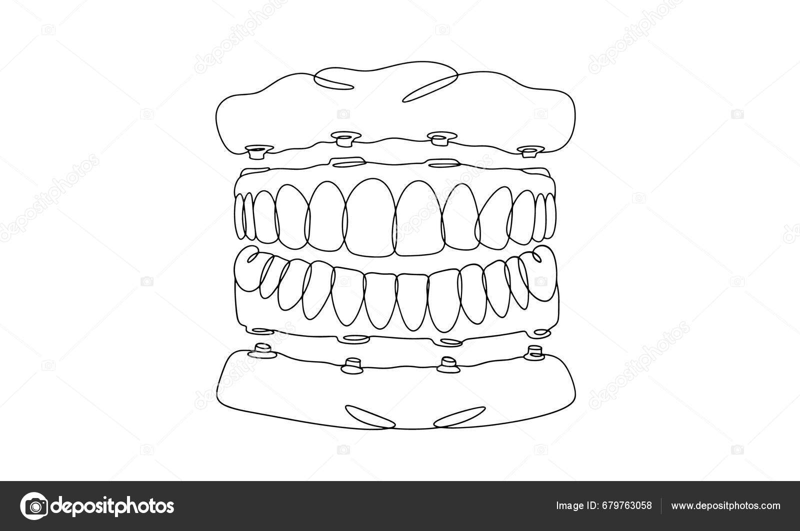 Implantation Dentures Upper Lower Jaw Complete Dental Restoration One ...