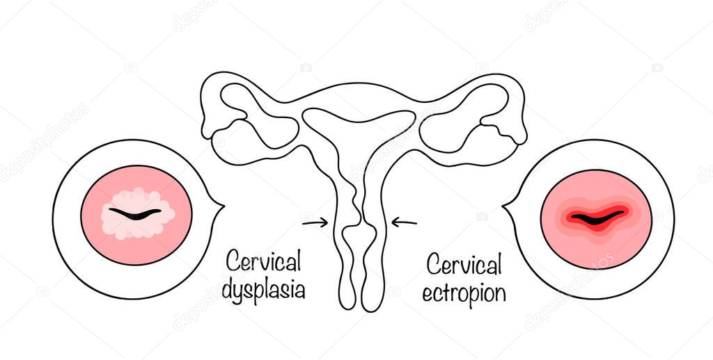 Displasia cervical y ectropión cervical. Cambios en el epitelio del ...