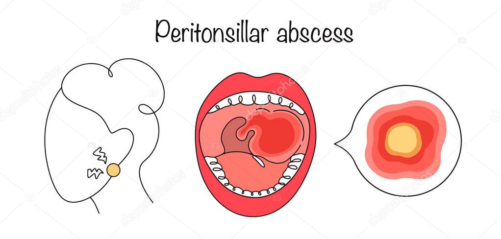 Peritonsillar abscess. Inflammatory disease of the soft tissues ...