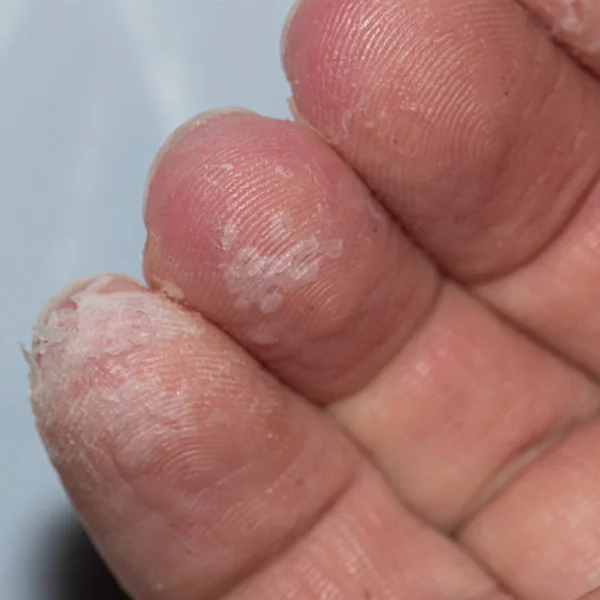 Ringworm feet Stock Photos, Royalty Free Ringworm feet Images ...