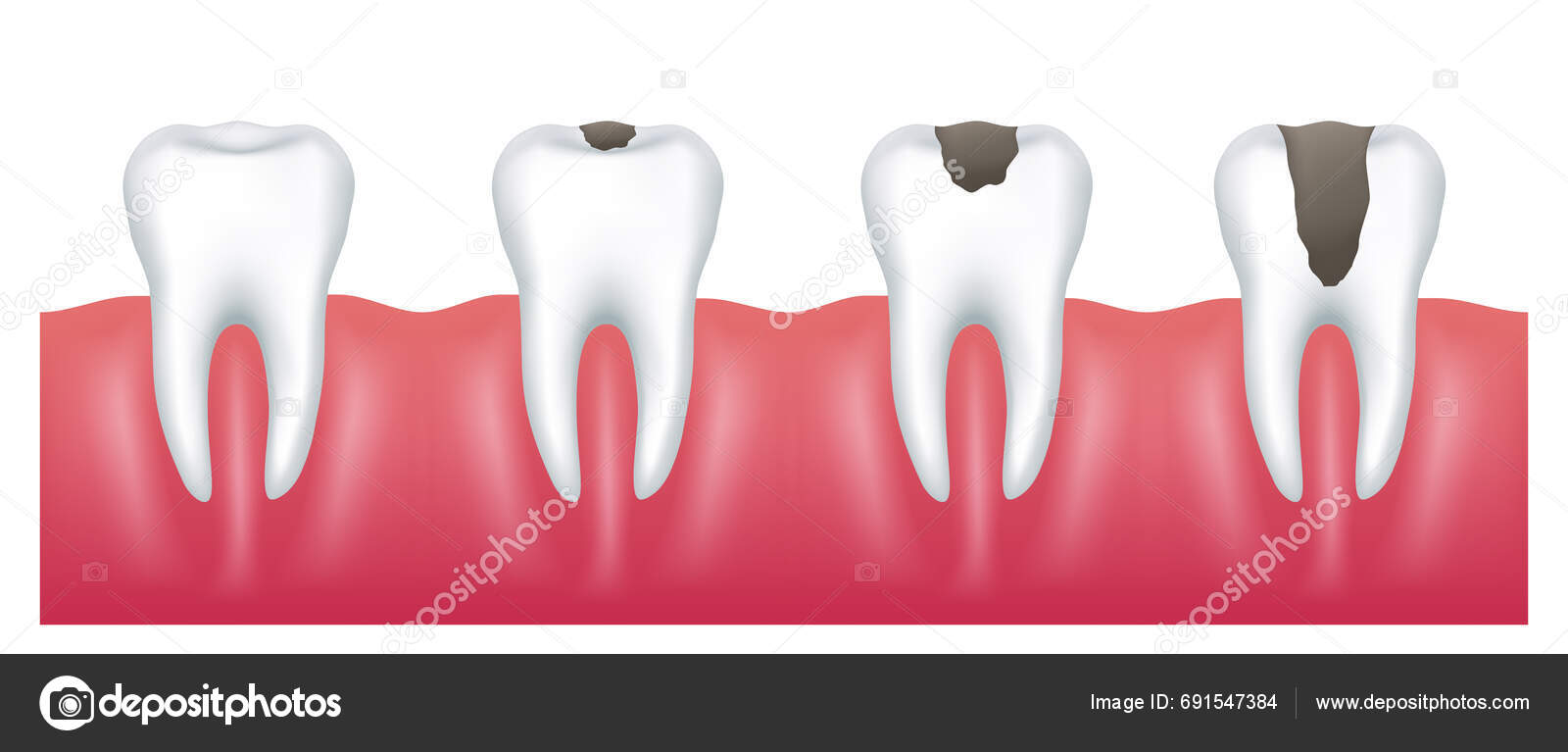 Friska Tänder Och Tänder Med Karies Vektorns Clipart vektor av ©pic_art ...
