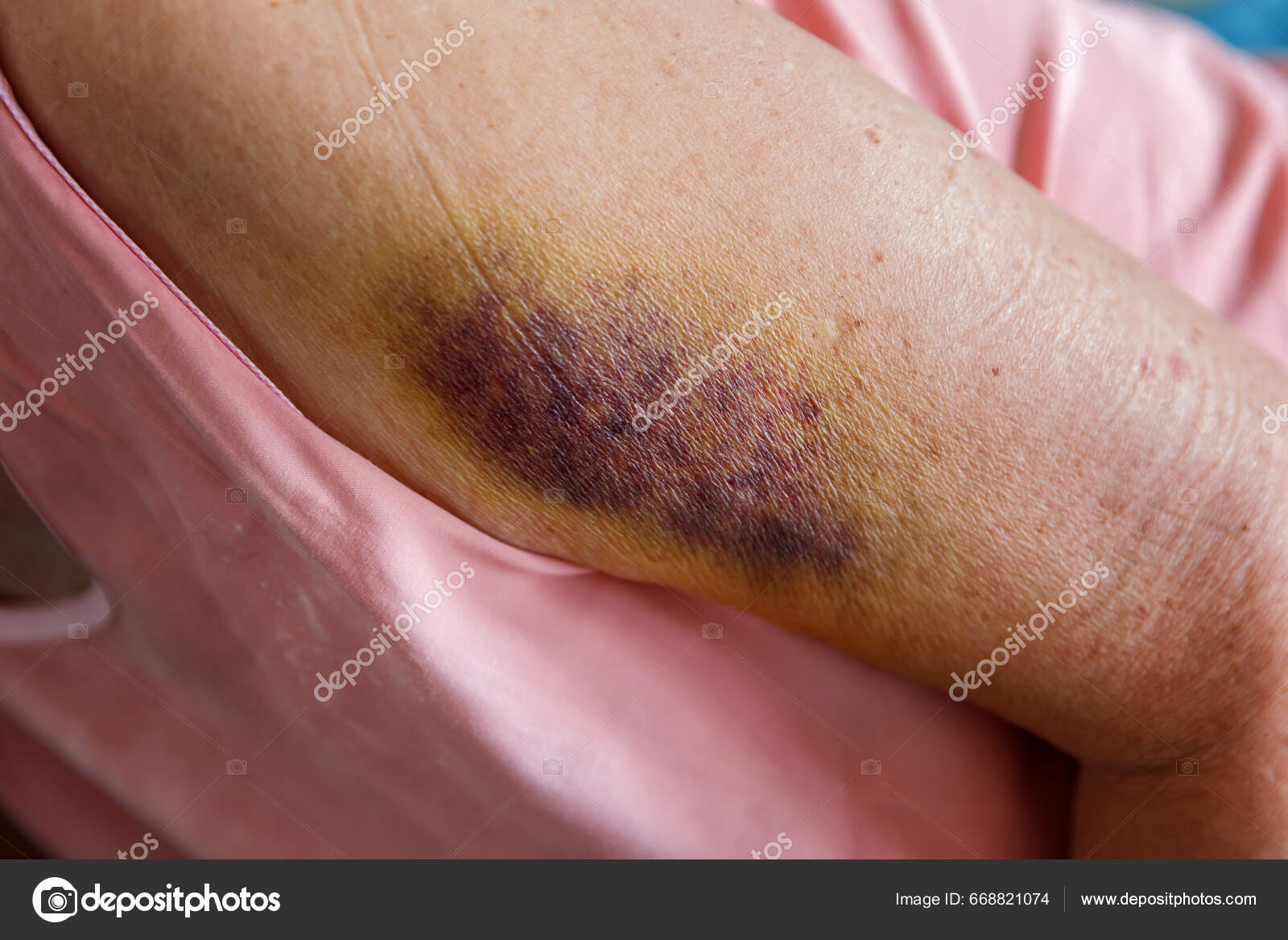 Hematomas Grandes Moretones Oscuros Brazo Una Persona Mayor Accidente ...