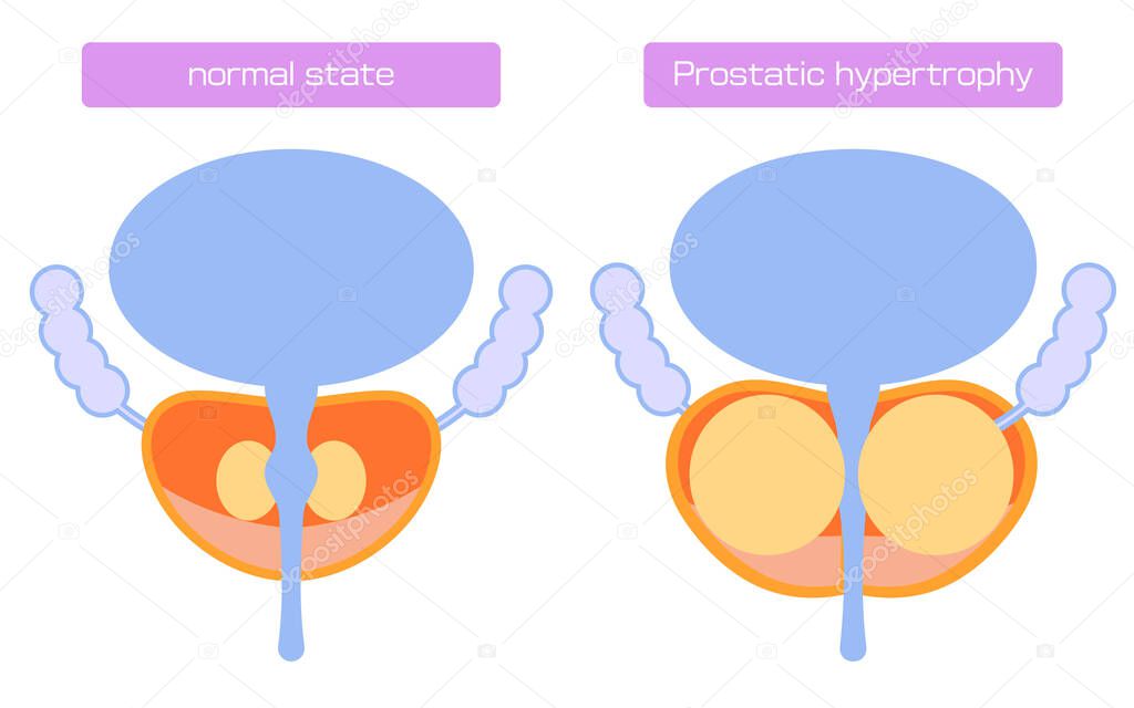 Ilustración de la hiperplasia prostática benigna 2023
