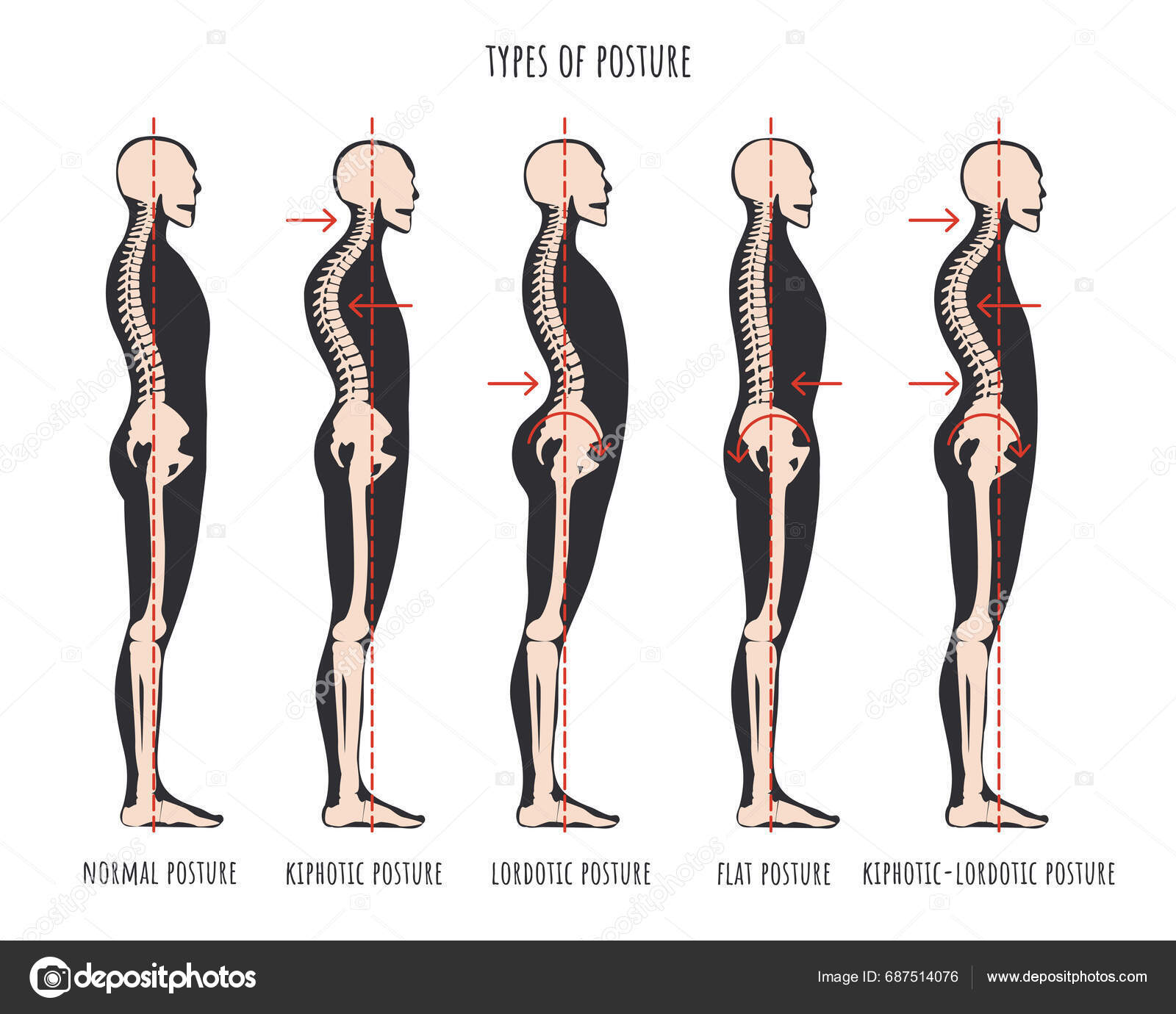 Tipo Postura Infografía Síndromes Posturales Muestras Esqueléticas ...