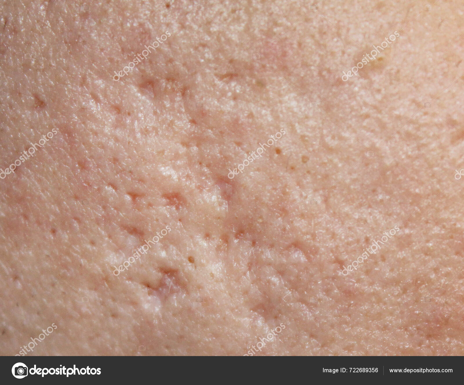 Problem Skin Acne Marks Stock Human Skin Texture Best Quality — Stock ...