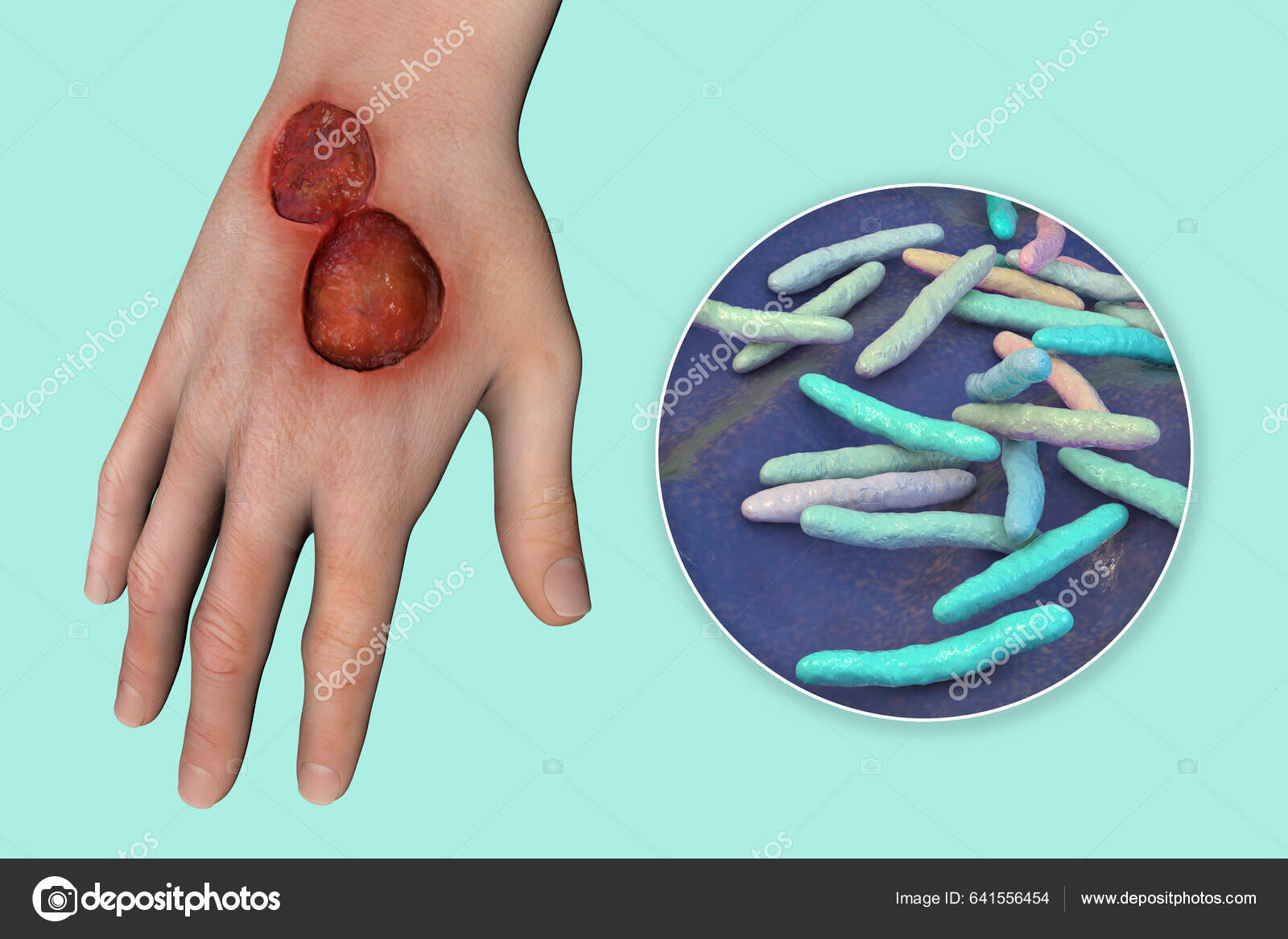 Úlcera Buruli Una Enfermedad Debilitante Crónica Que Afecta Piel Los ...
