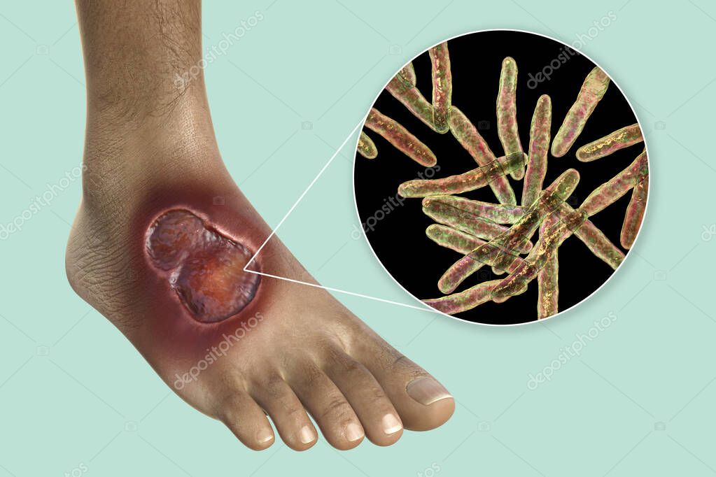 Buruli ulcer, a chronic debilitating disease affecting skin and ...
