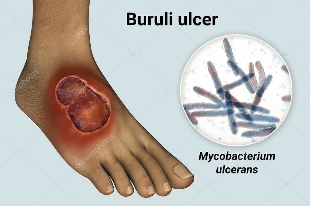 Buruli ulcer, a chronic debilitating disease affecting skin and ...