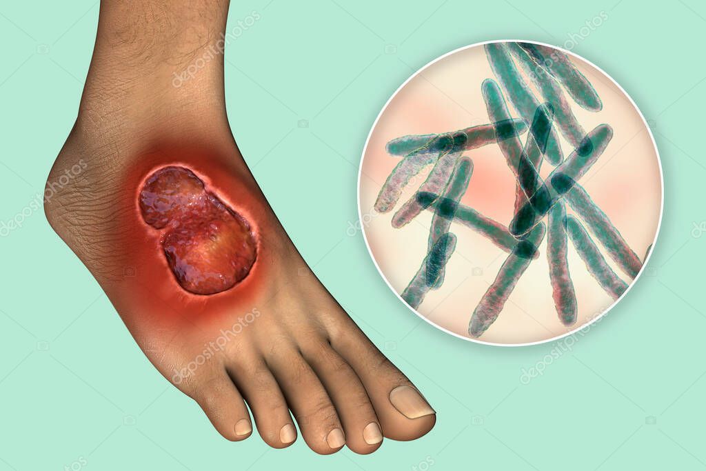 Buruli ulcer, a chronic debilitating disease affecting skin and ...